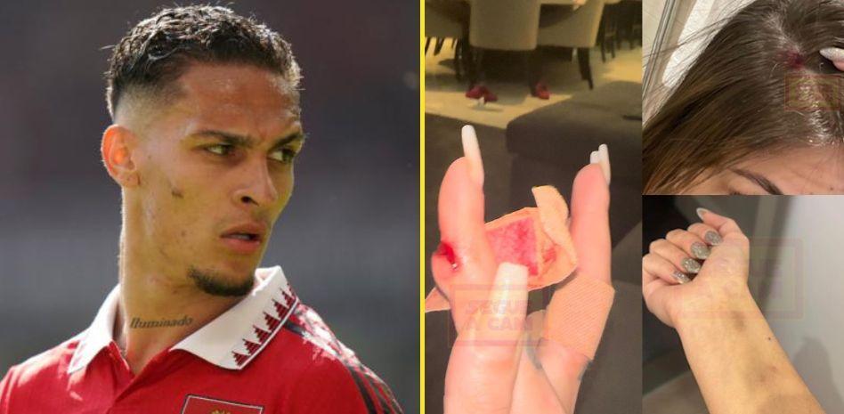 La ex-novia de Antony muestra cómo ha quedado tras una agresión del ...
